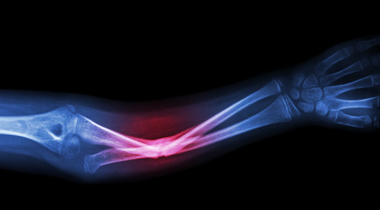 Understanding Non-Union Fractures: Causes, Symptoms, and Treatment ...