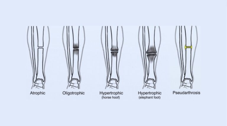 Understanding Non-Union Fractures: Causes, Symptoms, and Treatment ...