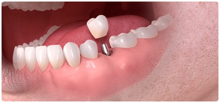 Turkey Teeth Explained: Understanding the Trend, Procedure, and Costs ...
